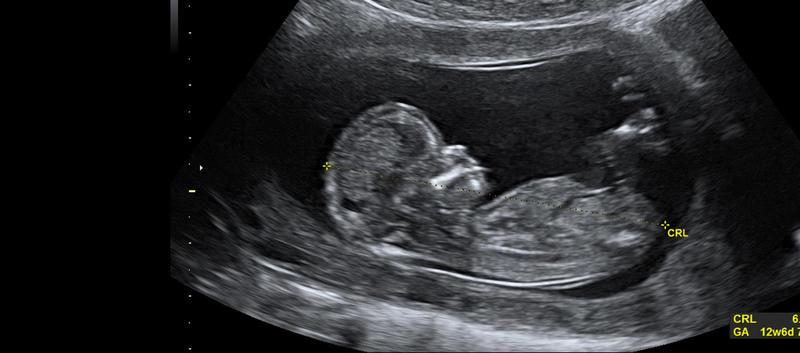 Genetic testing gives answers on developmental disorders during pregnancy