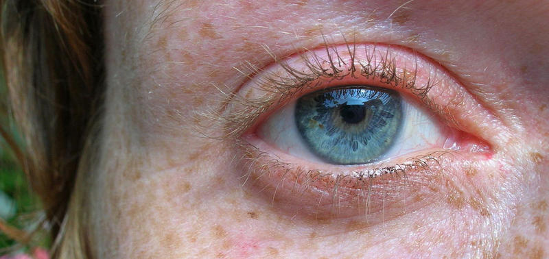 Red hair gene variant drives up skin cancer mutations