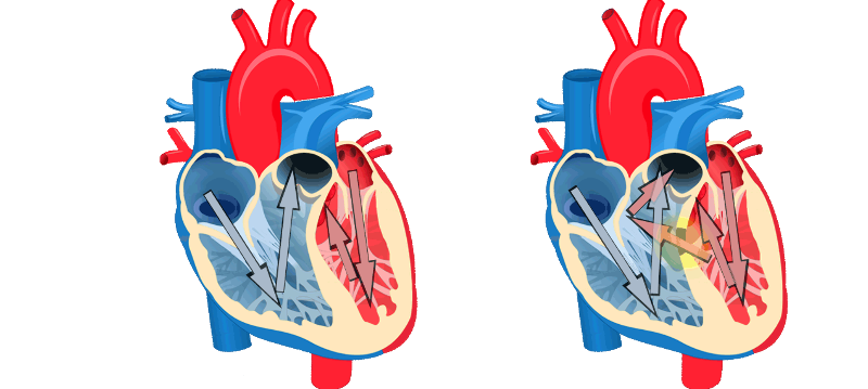 Largest genomic study of heart disease in children reveals inherited ...